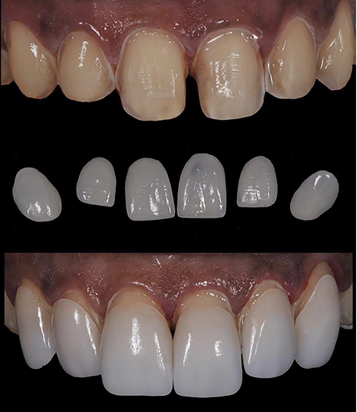 Carillas dentales. Lo que necesitas saber antes de utilizarlas en 6 ...